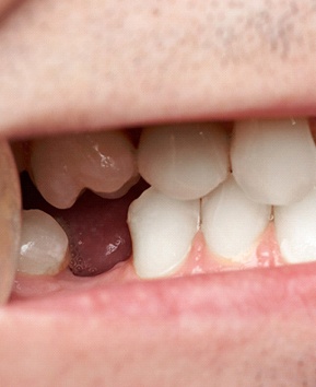 Single Tooth Dental Implants Phoenix | Bell Road Dental Care